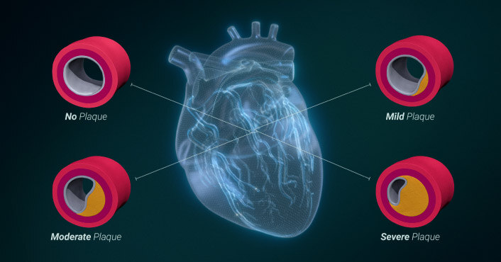 Coronary Arteries Diagram
